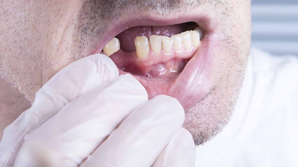 Top 3 Teeth Replacement Options for Adults with One or More Missing ...