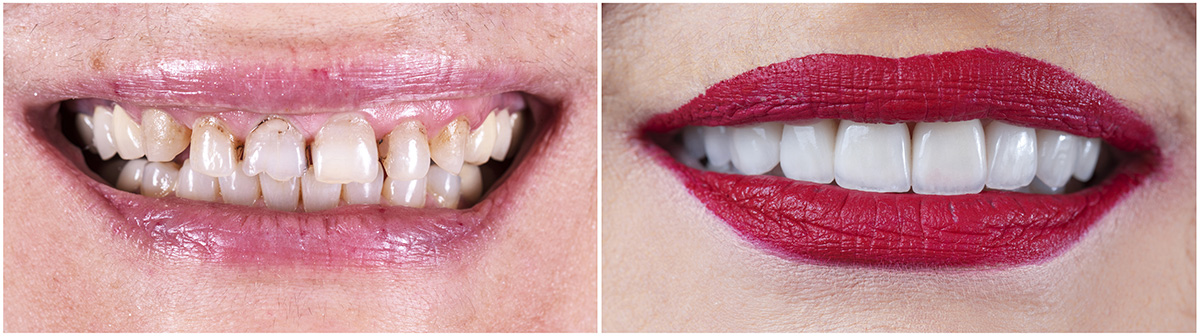 Porcelain Veneers North Hollywood | Victory Plaza Dental Group